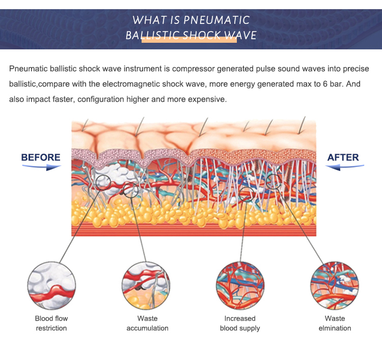 Vertical Dual Channel Physical Shockwave Machine Storz Sw14 Sw18 from ...
